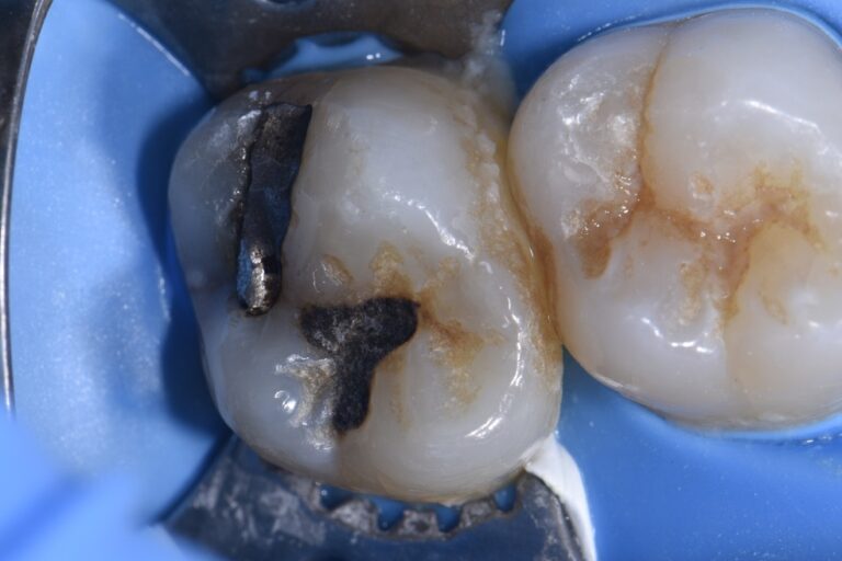 Amalgam removal and stain blockout