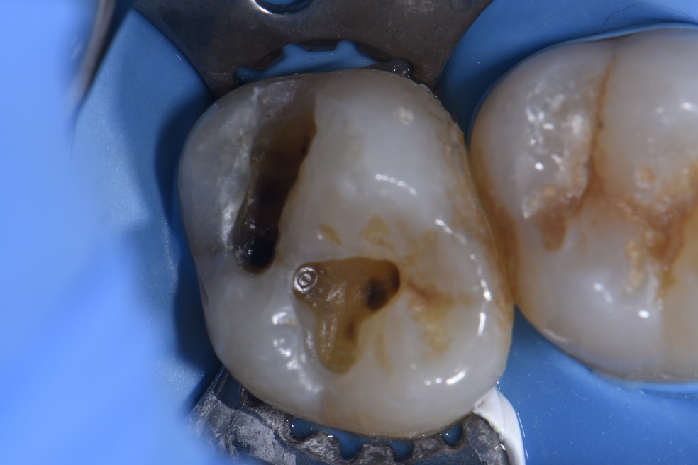 Amalgam removal and stain blockout
