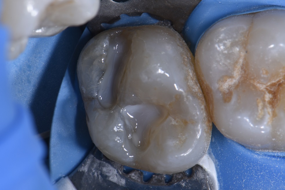 Amalgam removal and stain blockout