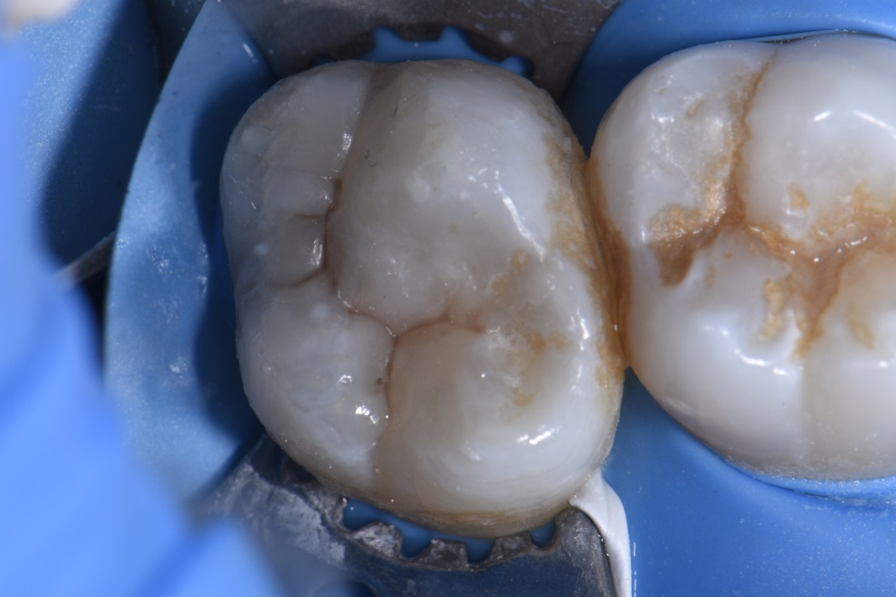 Amalgam removal and stain blockout