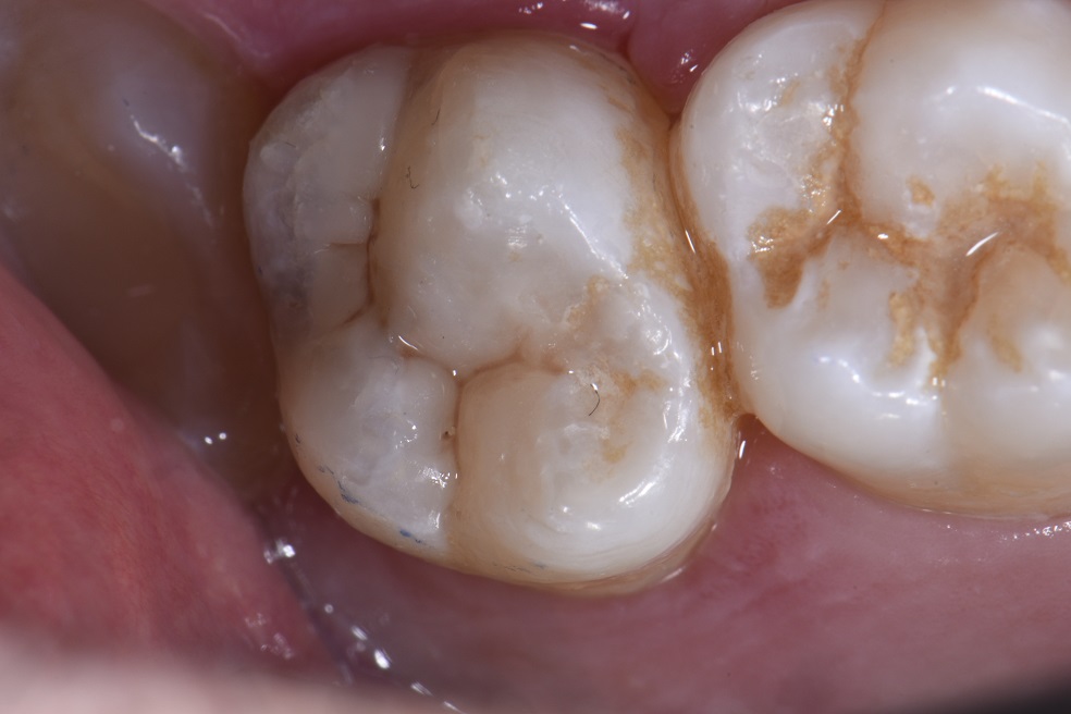Amalgam removal and stain blockout