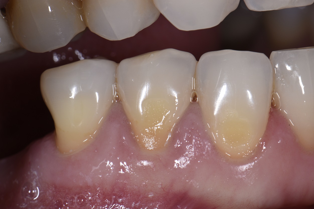 Cervical Abrasion Tooth Non Carious Cervical Lesions (NCCL) MedCrave