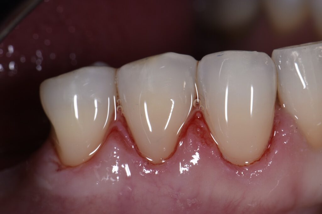 Sculpting Invisibility into Cervical Abrasion Lesions