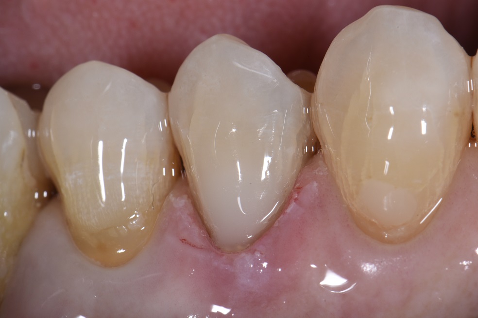 Class V replacement restorations root lightening