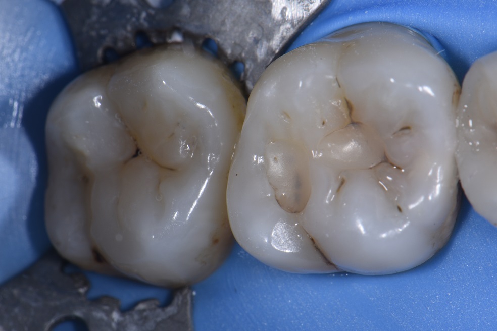 Class II Skulpting Mimicking Nature