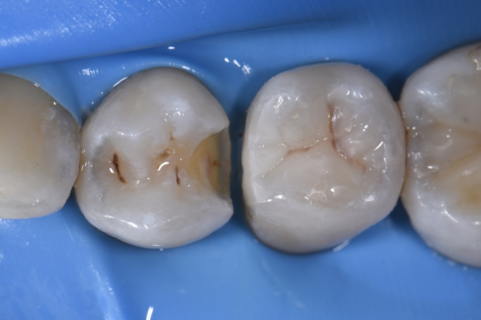 Back to Back cavities restored invisibly