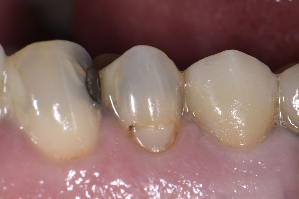 Class V GC Essentia U composite blend
