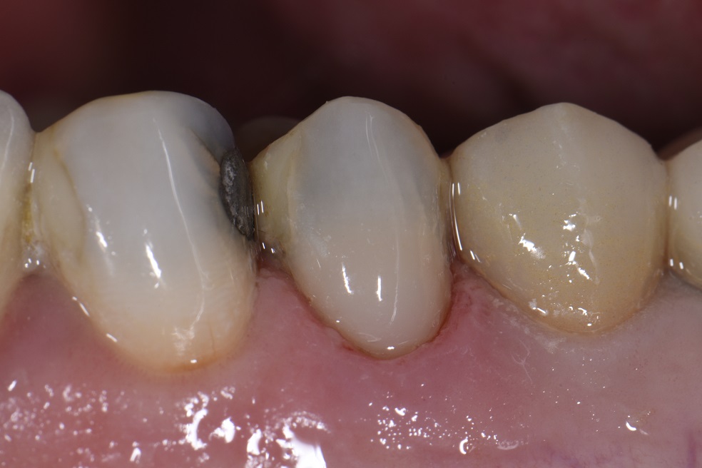 Class V GC Essentia U composite blend