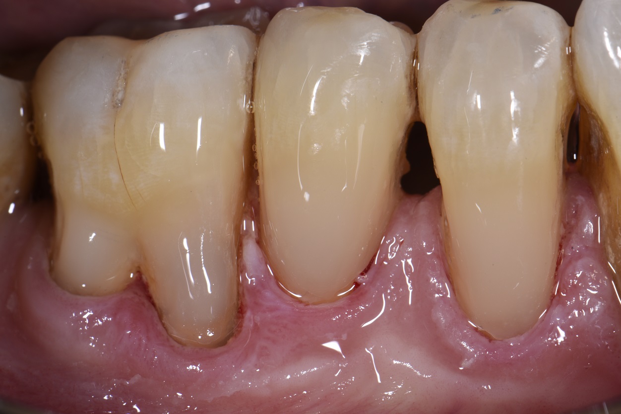 Types Of Abrasion In Dentistry at Hamish Gunther blog