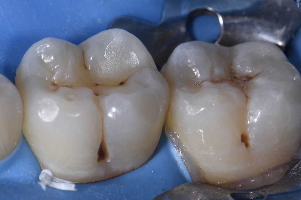 Sculpted fissurotomy and sealants to mimic nature