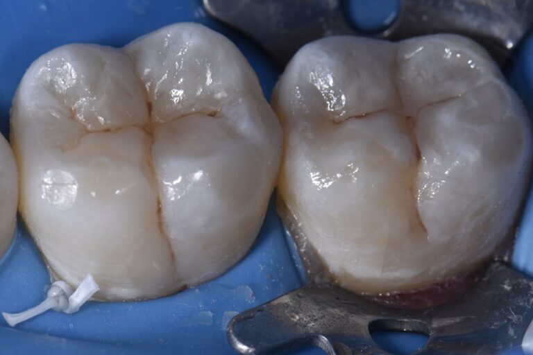 Sculpted fissurotomy and sealants to mimic nature