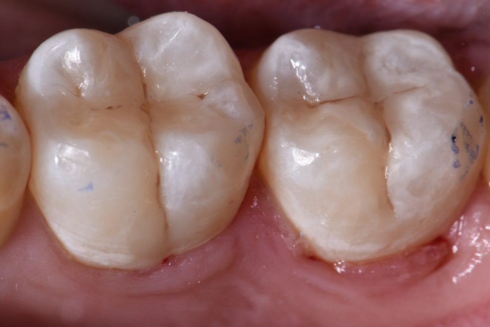 Sculpted fissurotomy and sealants to mimic nature