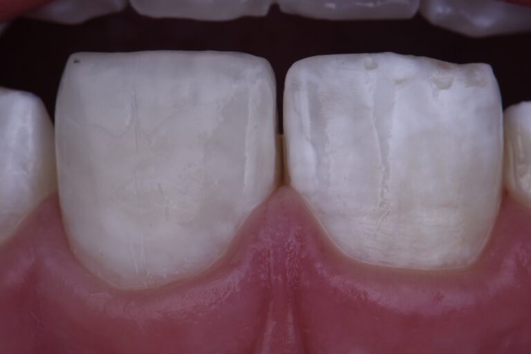 Restoring a Hypomineralized tooth fracture to look natural