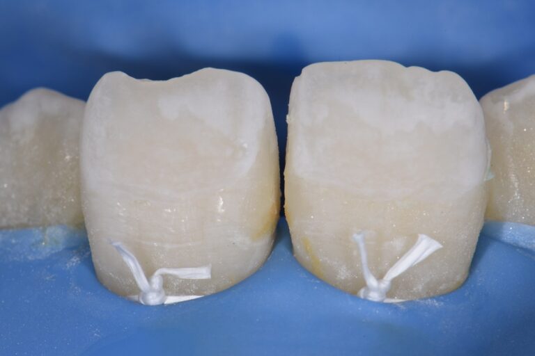 Resin infiltration with composite resin direct restoration combination ...