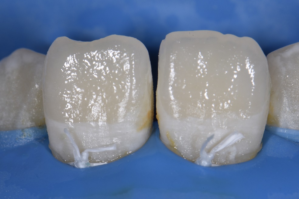 Resin infiltration with composite resin direct restoration combination ...