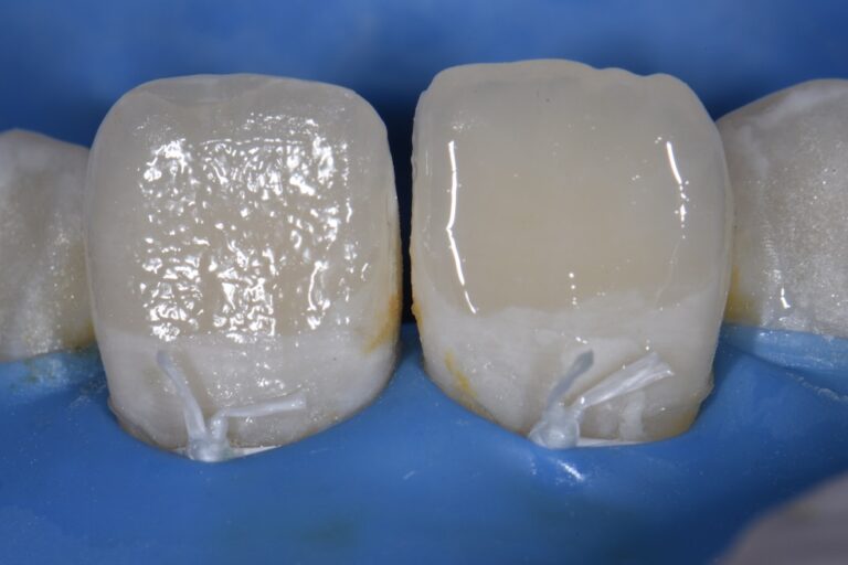 Resin infiltration with composite resin direct restoration combination ...