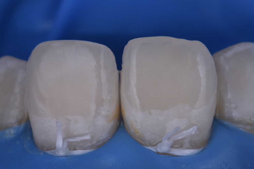 Resin infiltration with composite resin direct restoration combination ...