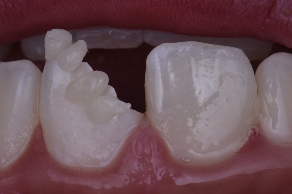 GC Prototype Class IV composite