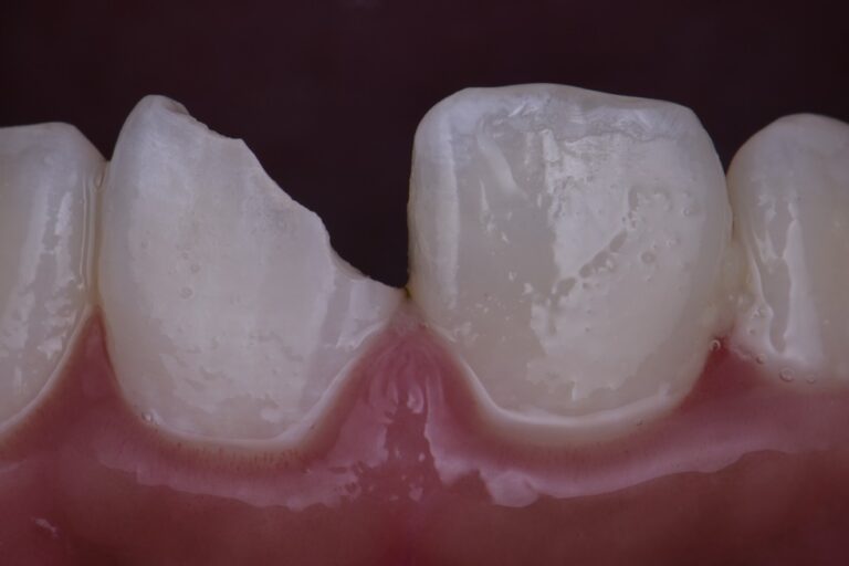 GC Prototype Class IV composite