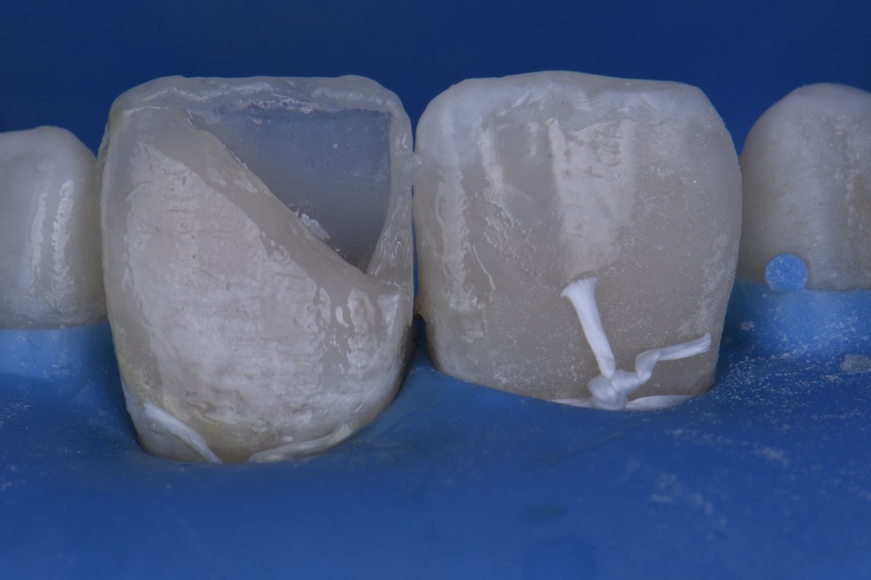 GC Prototype Class IV composite