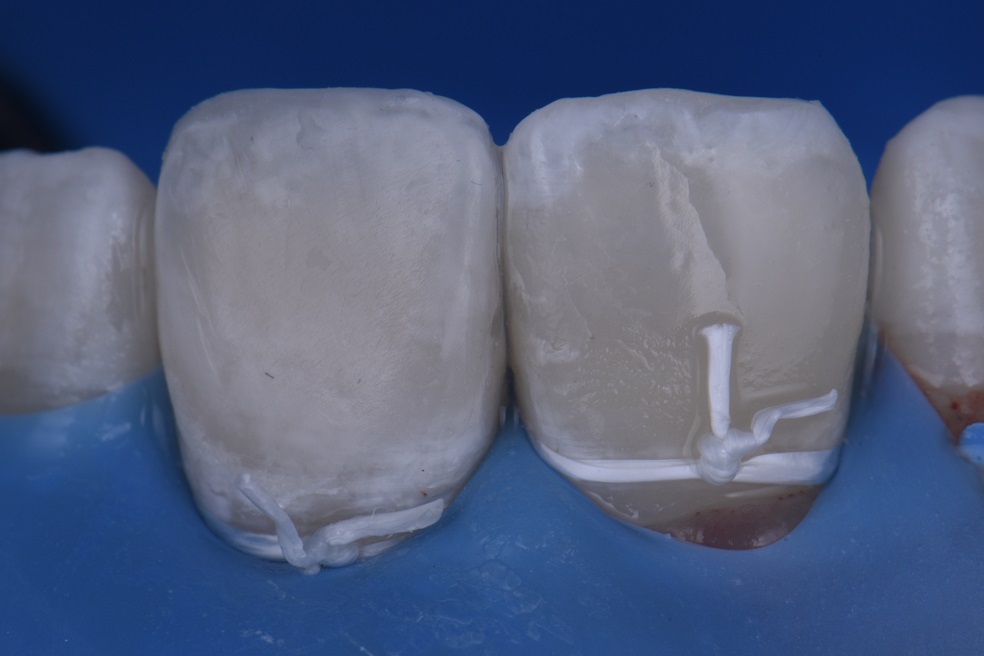 GC Prototype Class IV composite