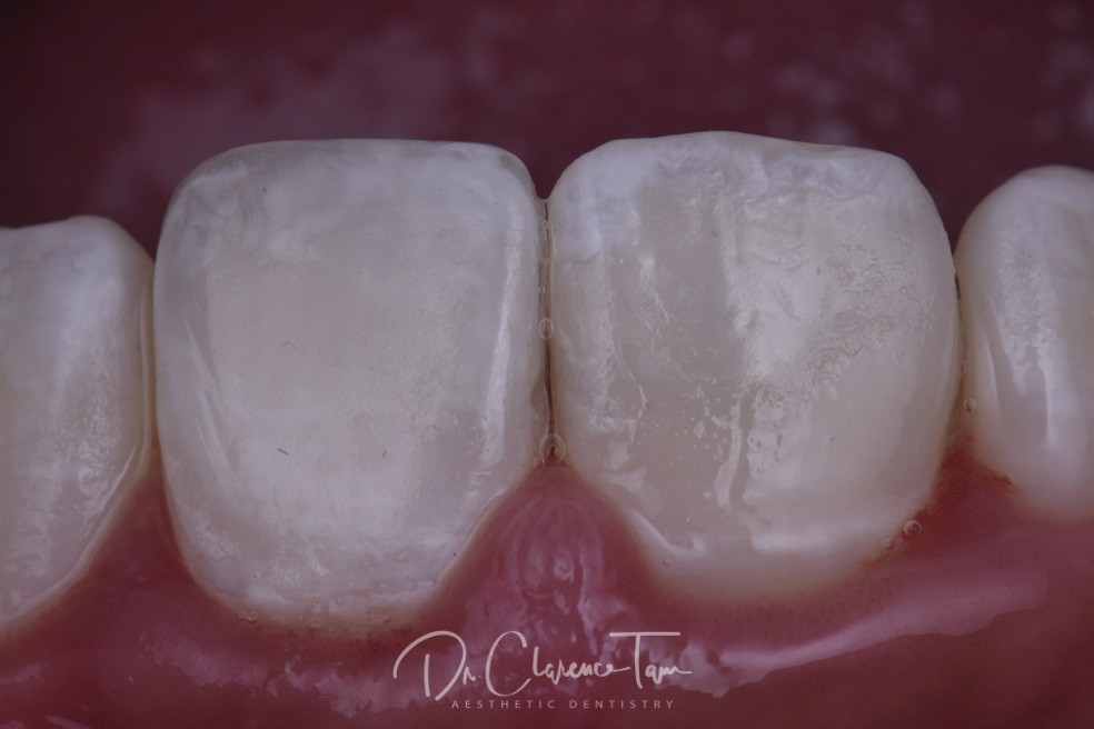 GC Prototype Class IV composite