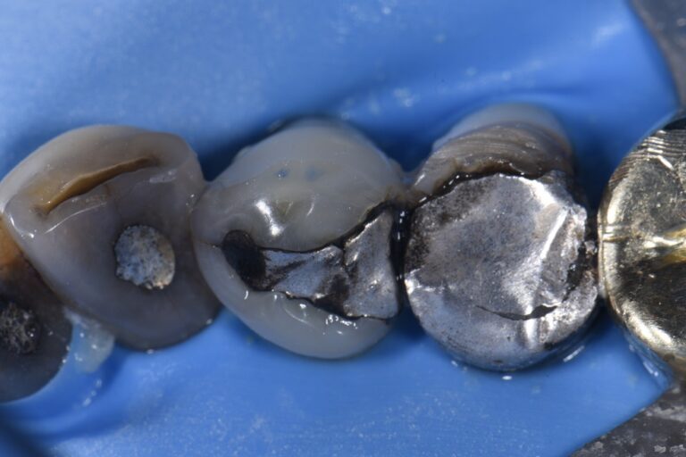 Deep Amalgam staining biomimetic composite