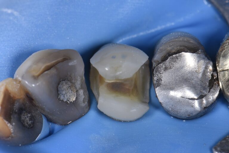 Deep Amalgam staining biomimetic composite