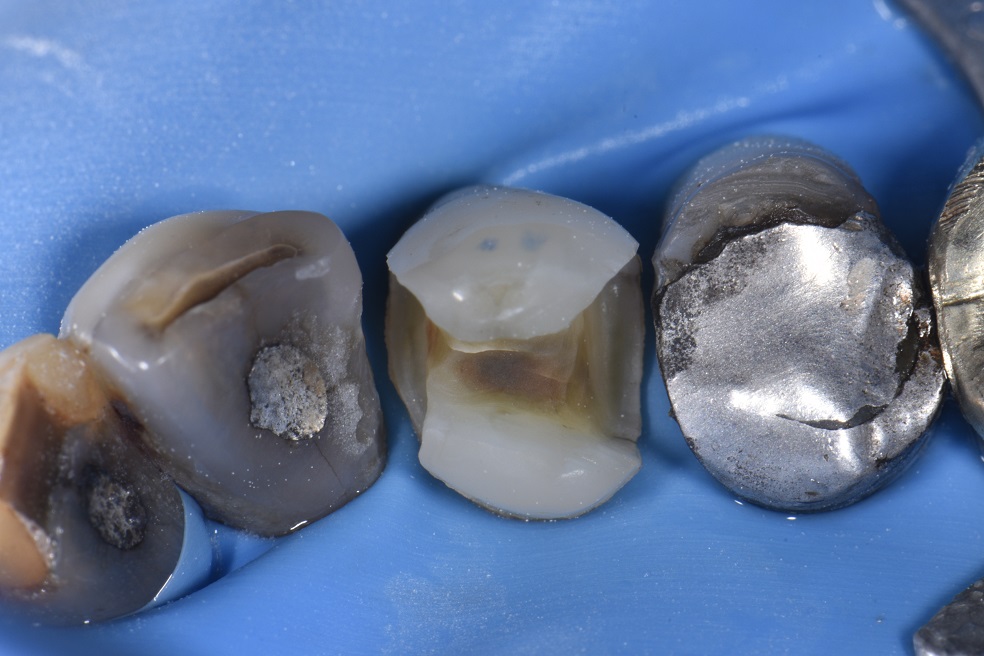 Deep Amalgam staining biomimetic composite