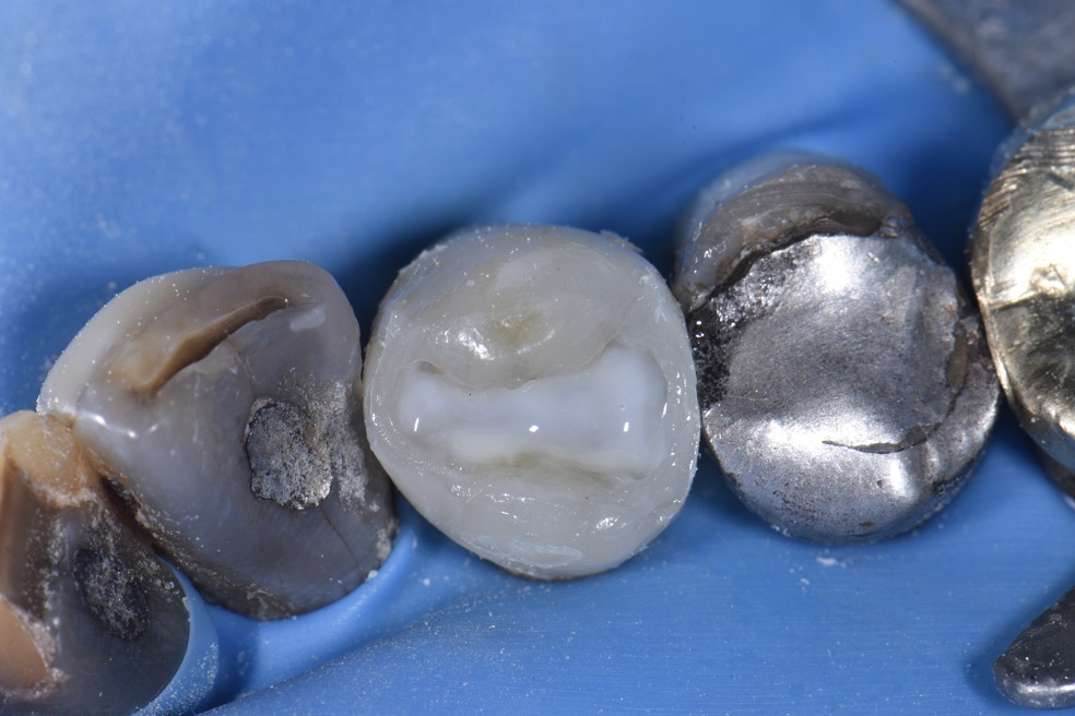 Deep Amalgam staining biomimetic composite