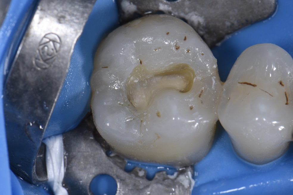 Class I replacement using a modern supercomposite