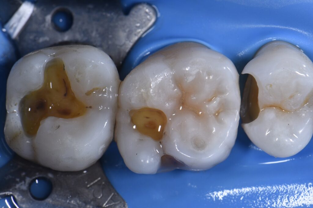 GC Prototype Composite in Quadrant Dentistry