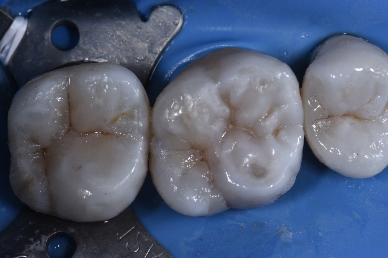 GC Prototype Composite in Quadrant Dentistry