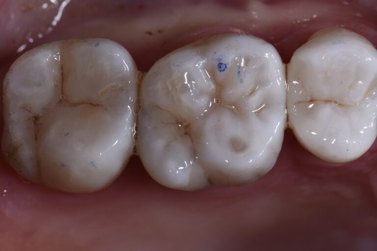 GC Prototype Composite in Quadrant Dentistry