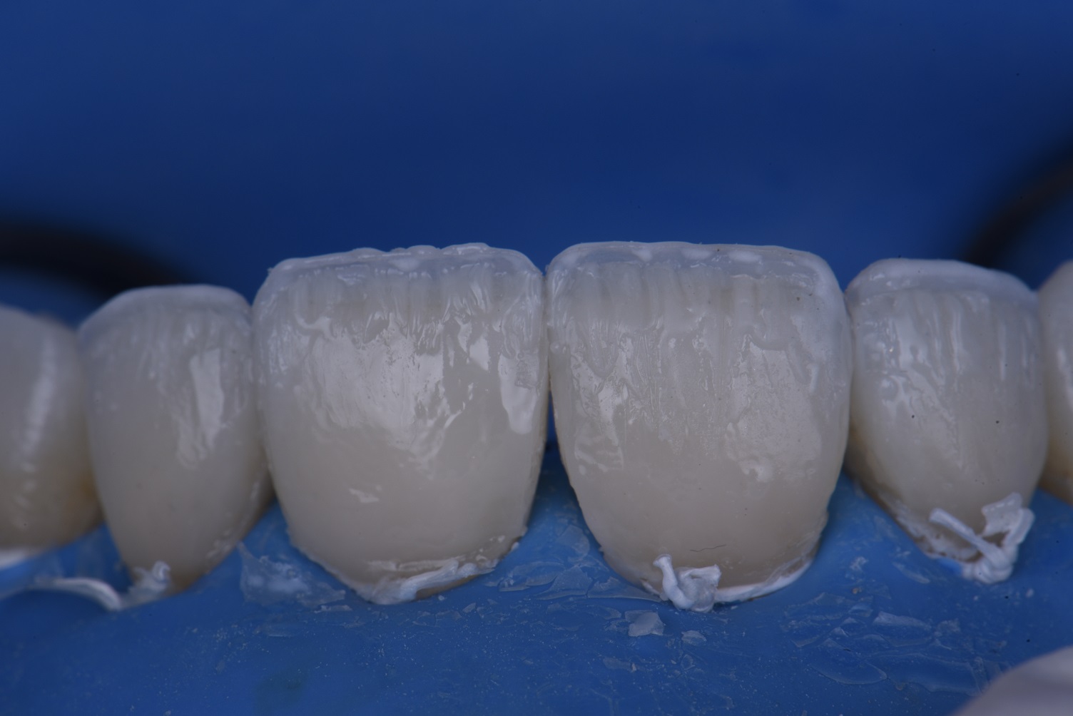 Reproportioning Teeth with Beautifully Layered Composite Veneers