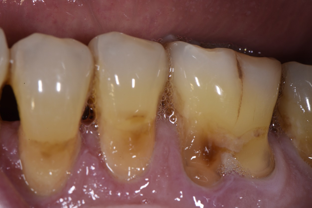 Class V cervical protection with composite resin
