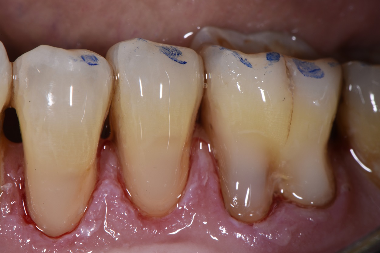 Class V cervical protection with composite resin