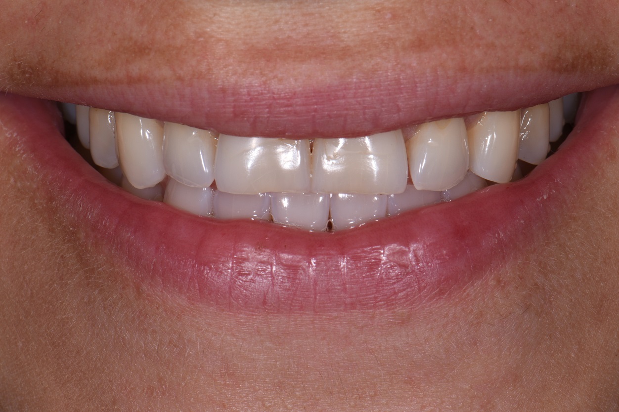 Combination Digital Aligners and Guided Composite Veneers