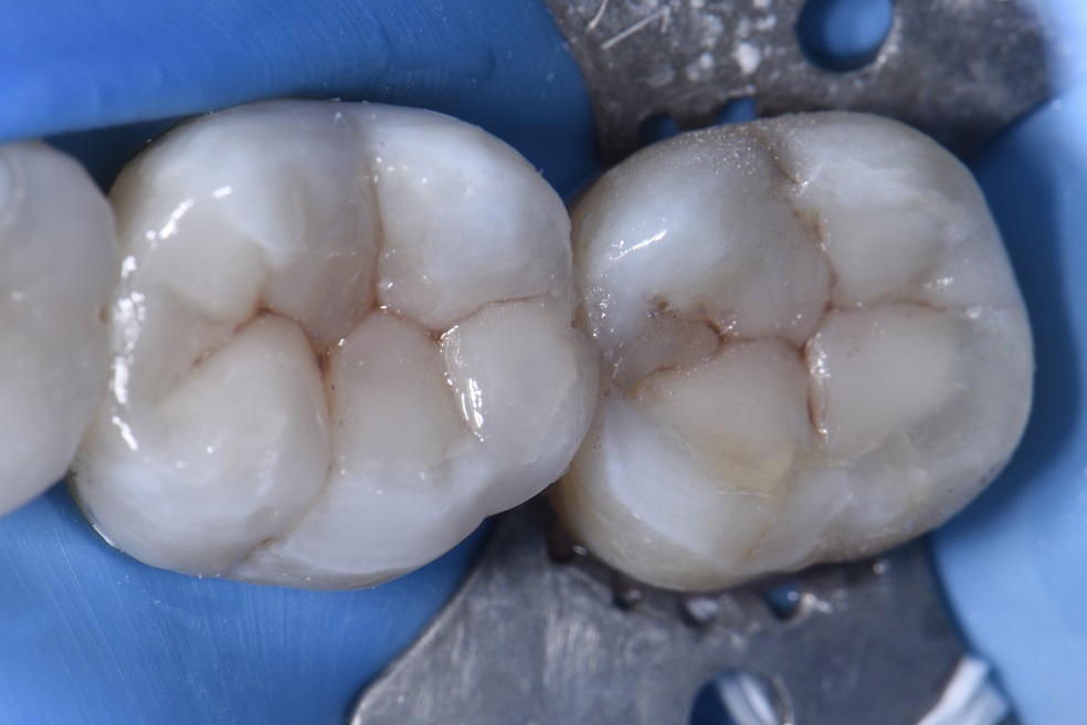 Replacing Leaking Old Composite Fillings