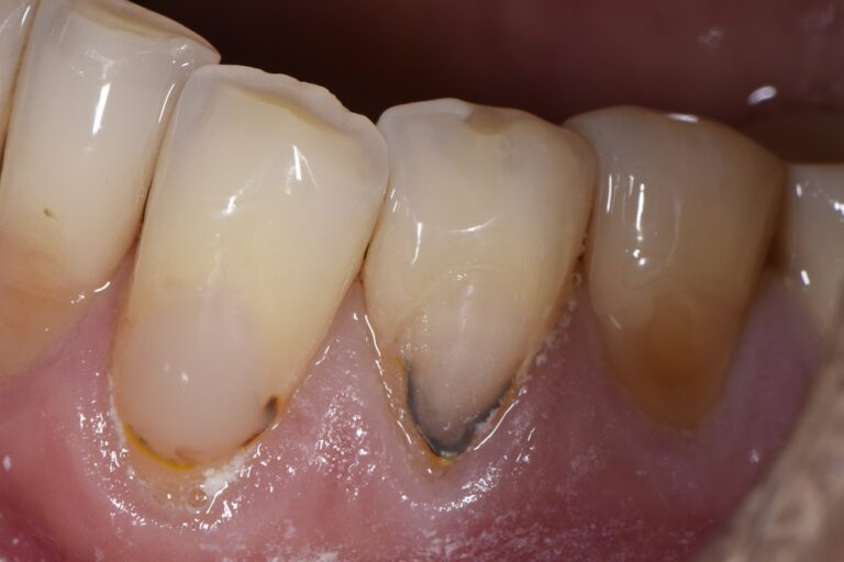 Replacing unesthetic Class V restorations with well blended composite