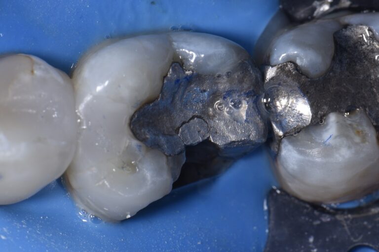 Freehand direct reconstruction of a heavily restored tooth