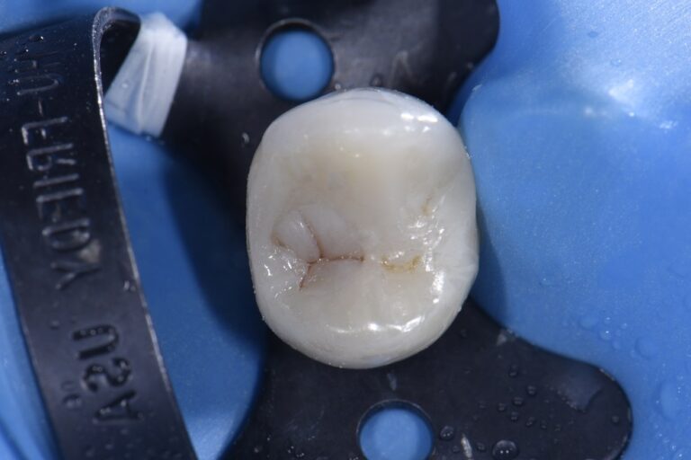 Implant Closure Restorations