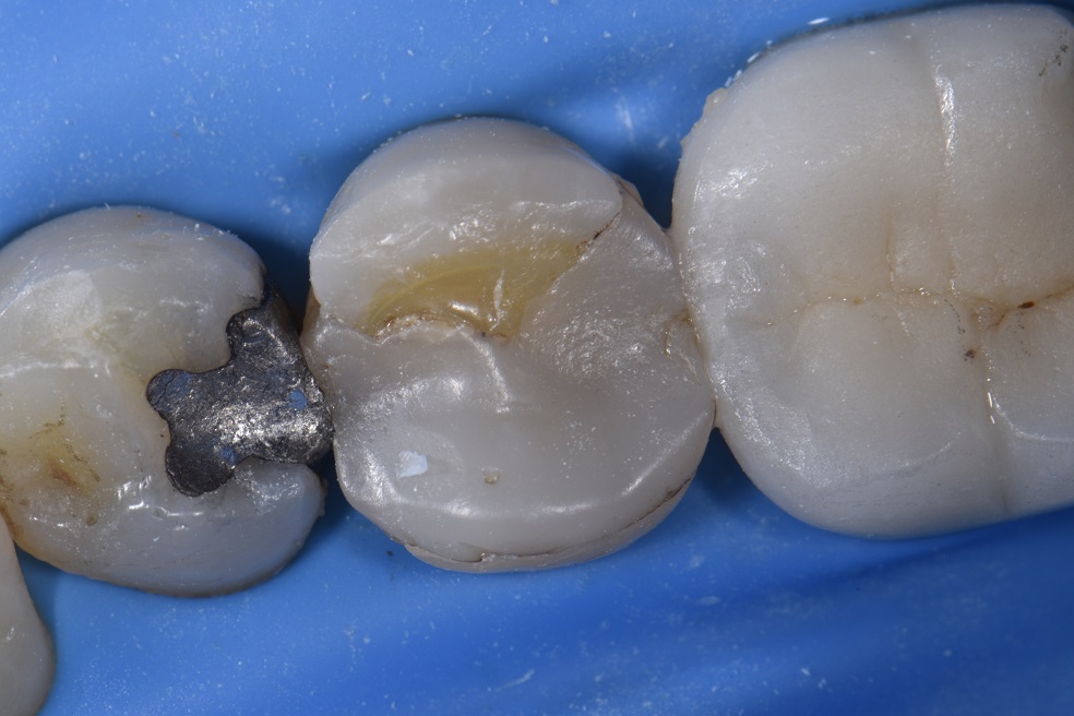 Large Class II Reconstructions using Direct Composite Resin