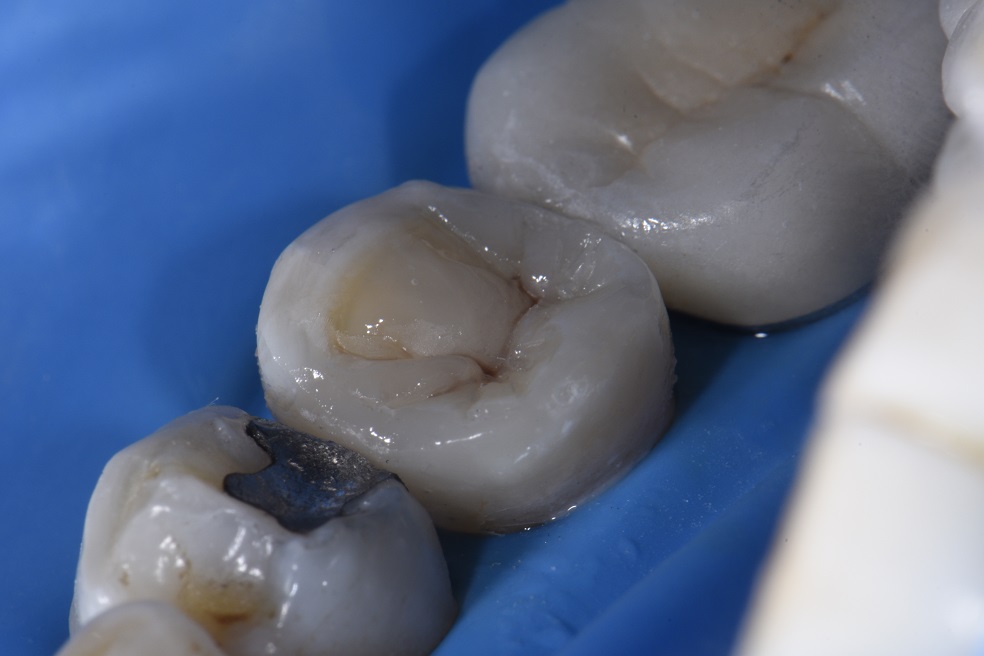 Large Class II Reconstructions using Direct Composite Resin