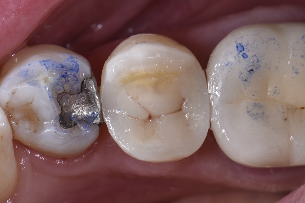 Large Class II Reconstructions using Direct Composite Resin