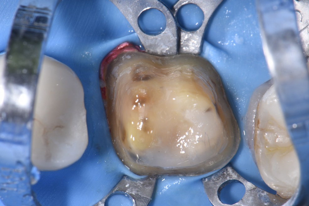 Molar Isolation with Supplemental Clamps under Rubber Dam