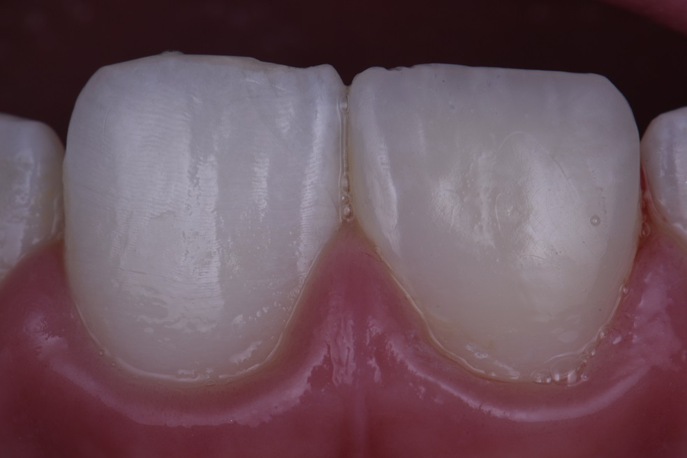 Partial Composite Repairs to Front Teeth
