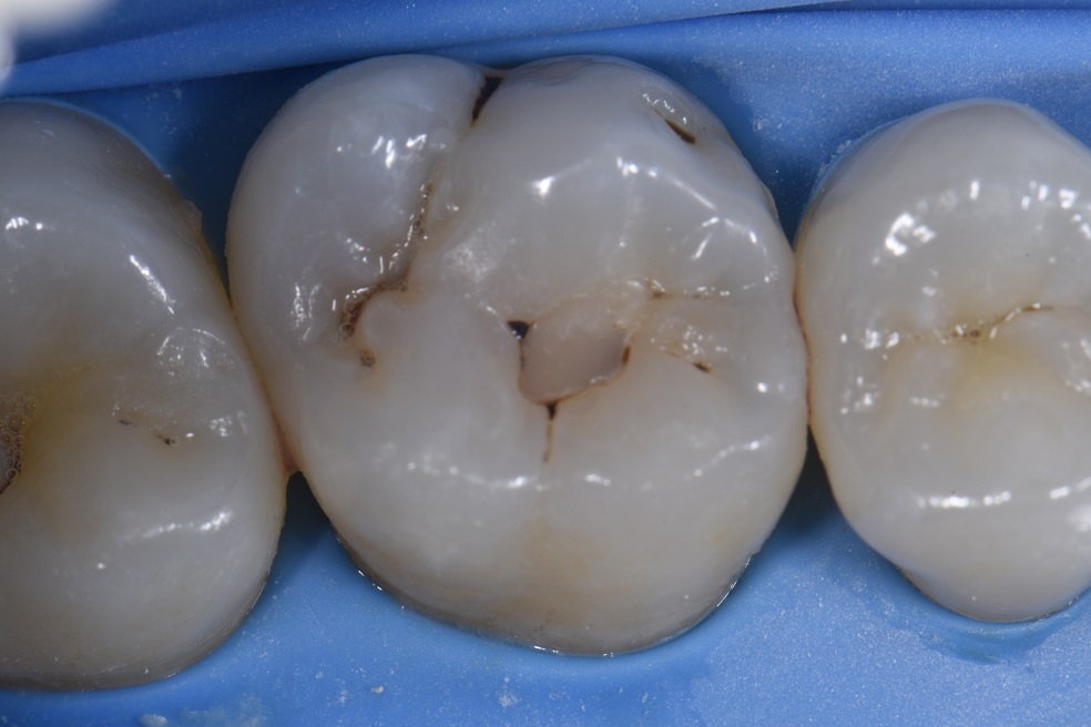 Fissure Exploration and Old Filling Removal