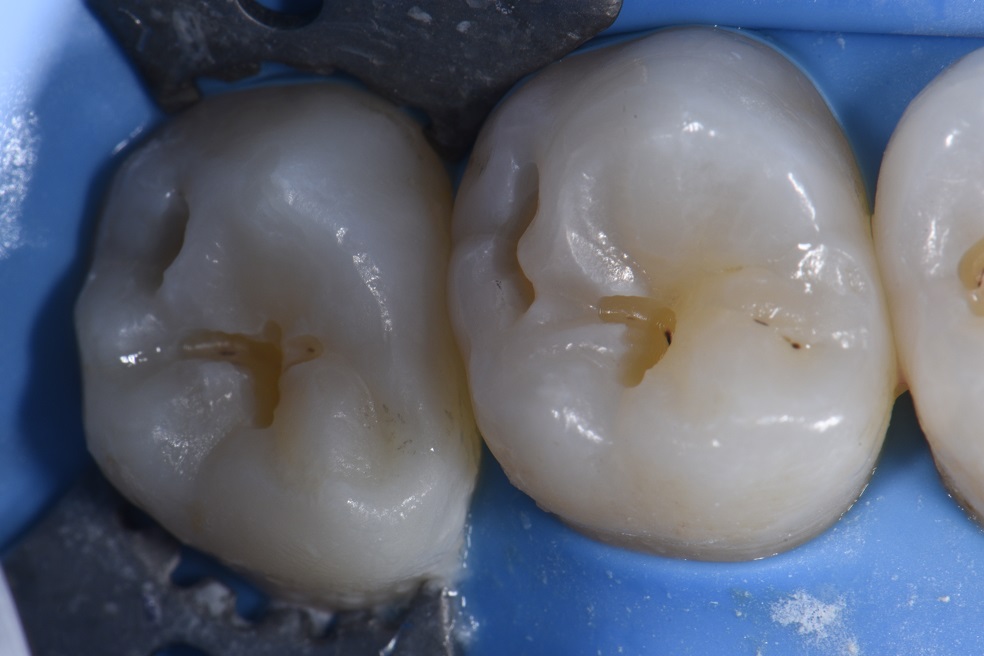 Deep Fissurotomy Restorations