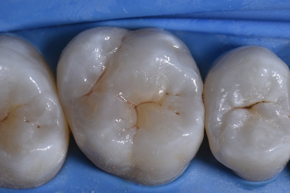 Fissure Exploration and Old Filling Removal